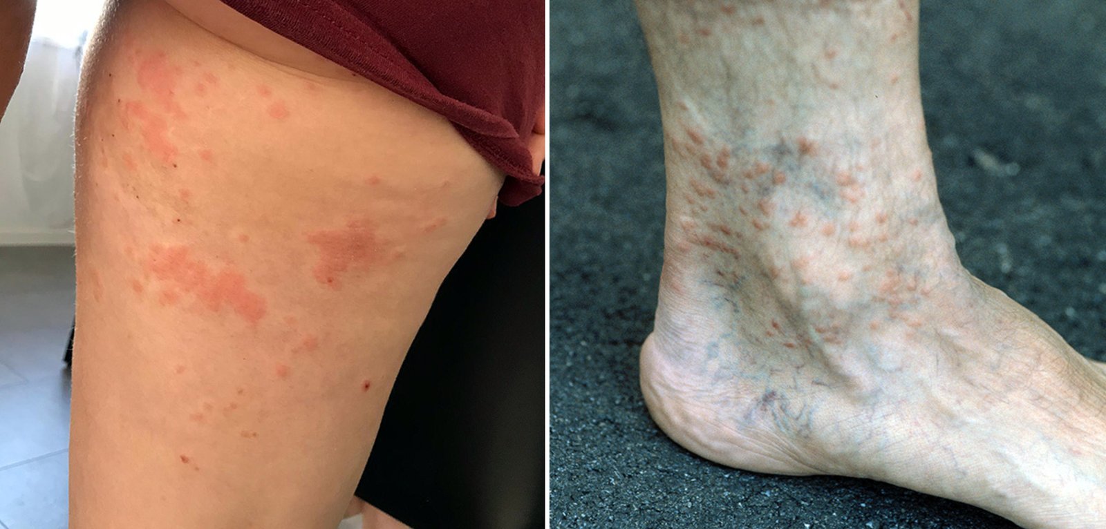 Beware of caterpillars with urticating hairs